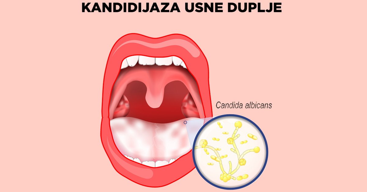 Oralna kandida je neprijatna bolest koja ume da se „otme kontroli ...