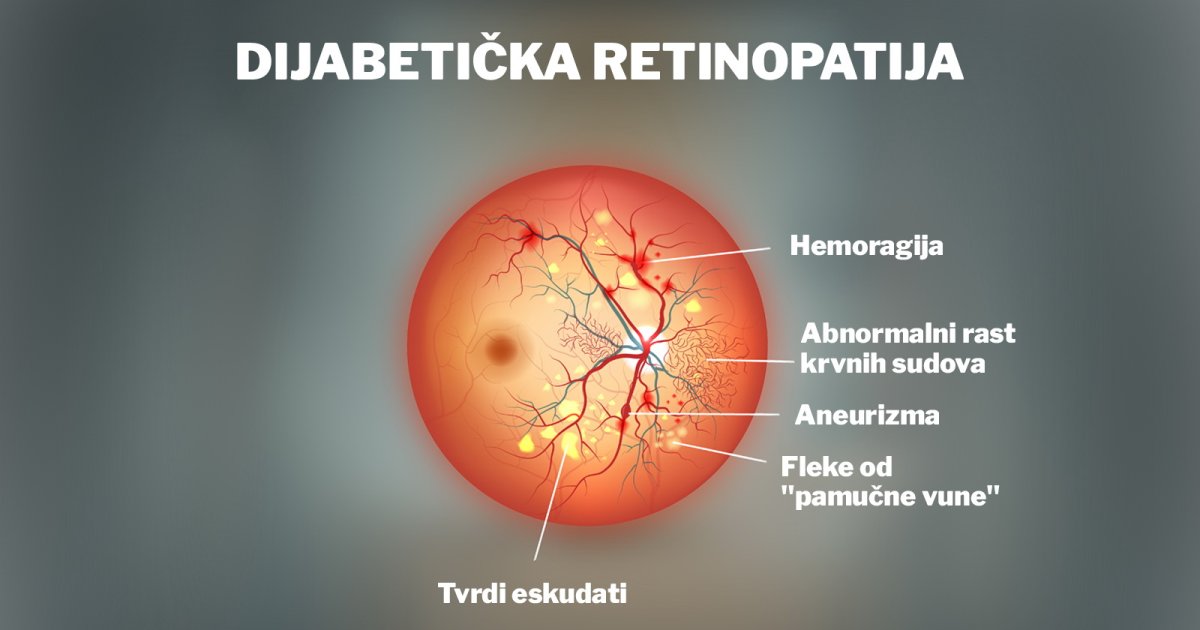 Zabrinjavajući broj mladih sa dijabetesom tipa 2 ima oštećenje oka ...
