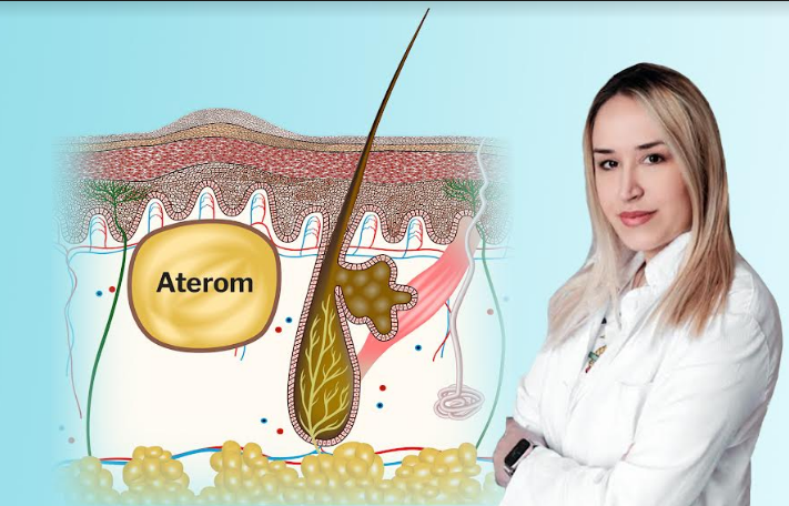 Šta je aterom, kako nastaje i kako se leči, odgovara dr Nina Mićić ...