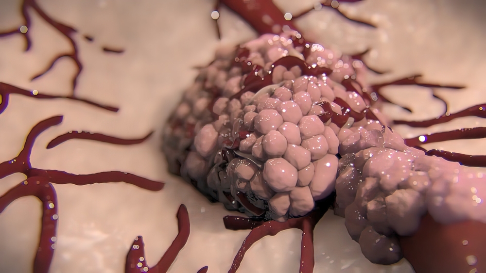 Sarkom je uvek maligni tumor koji počinje u mekom tkivu ili kostima ...