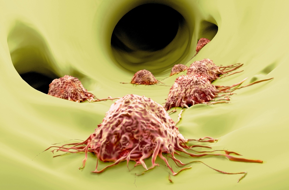 Širenje karcinoma po telu signalizira jedna tipična vrsta bola - eKlinika