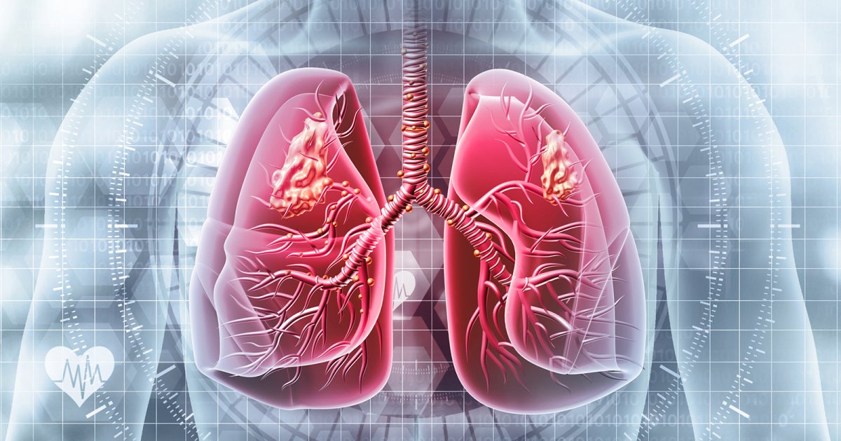 Rak pluća poprima razmere epidemije, počinje skrining na njegovo rano otkrivanje - eKlinika