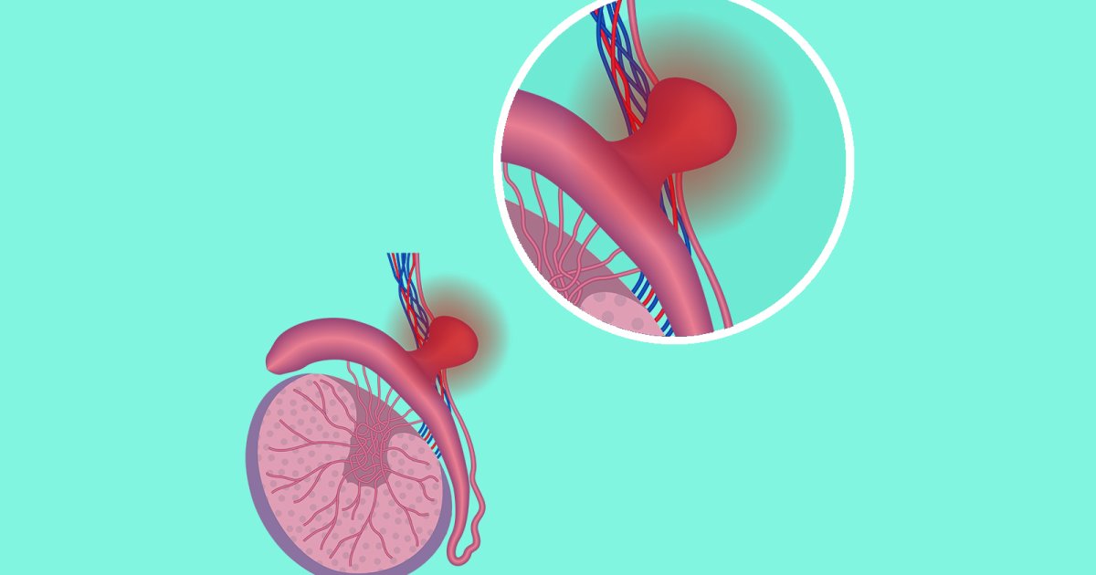 Šta su spermatocele koje se javljaju kod jednog od 3 muškarca - eKlinika