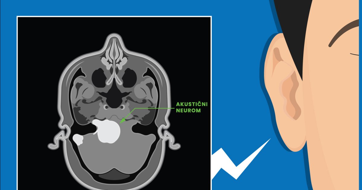Slabljenje sluha i vrtoglavica mogu ukazati na tumor, šta je i kako se ...