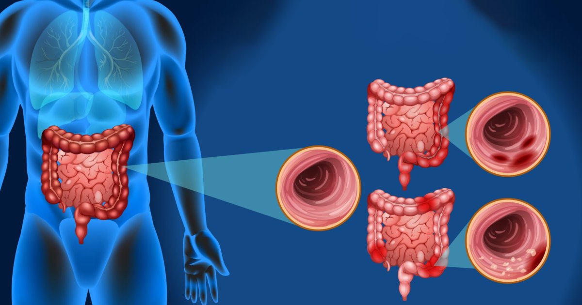 5 tipičnih simptoma koji mogu ukazati na ozbiljnu bolest creva - eKlinika