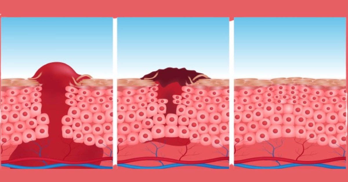 Ubodne rane i posekotine: Kada nastupaju komplikacije? - eKlinika
