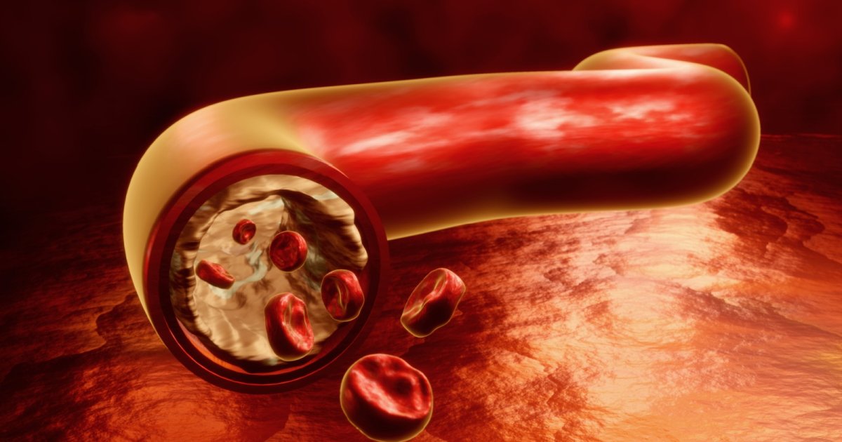 Kako bolest perifernih arterija utiče na naše telo - eKlinika