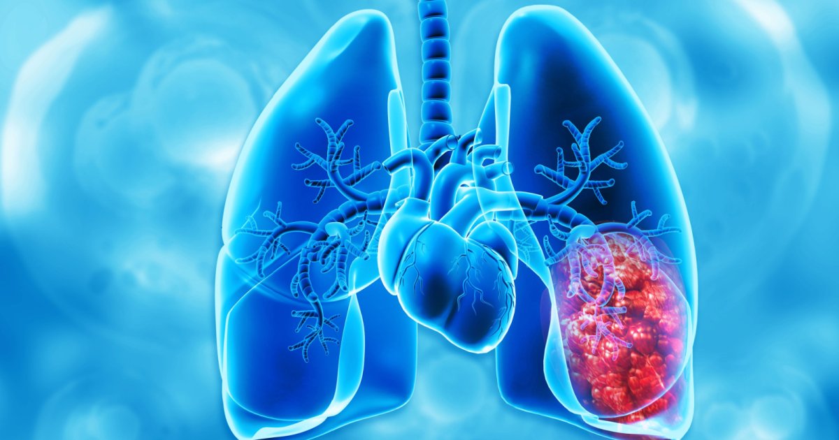 Kako sprečiti i prevenirati rak pluća: Uskoro skrining na rano otkrivanje i u Srbiji - eKlinika