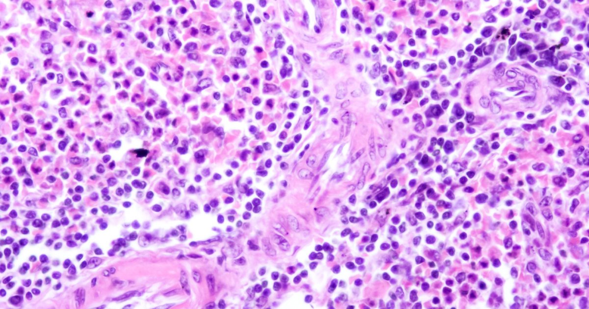 Šta je PEComa – redak tumor koji se može javiti bilo gde u telu - eKlinika