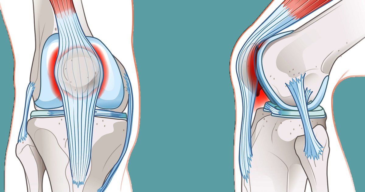 Da li ćemo dobiti osteoartritis ili oštetiti hrskavicu ako nam „krckaju ...