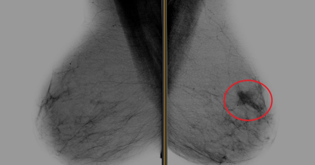 Jednokratna doza zračenja pre operacije može da iskoreni rak dojke u ...